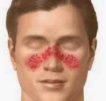 Jenis Penyakit Autoimun Dan Gejalanya - Pasien Sehat