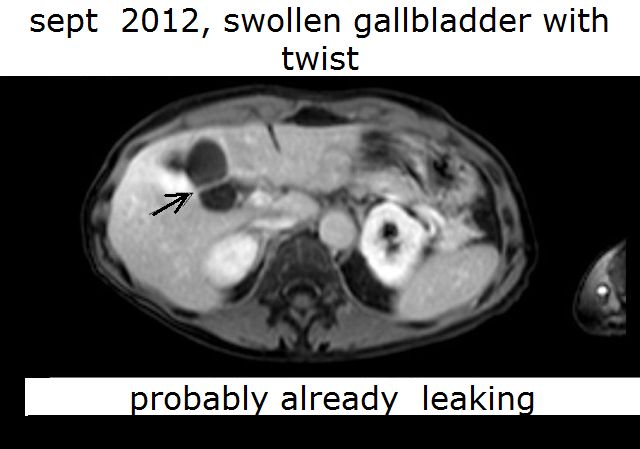 hourglass gallbladder