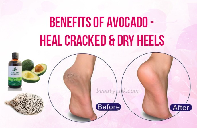 Spread This Powerful Avocado Mixture On Feet Twice a Week to Heal Dry ...