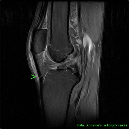 Dr Balaji Anvekar FRCR: MRI Artifacts : Magic Angle Effect