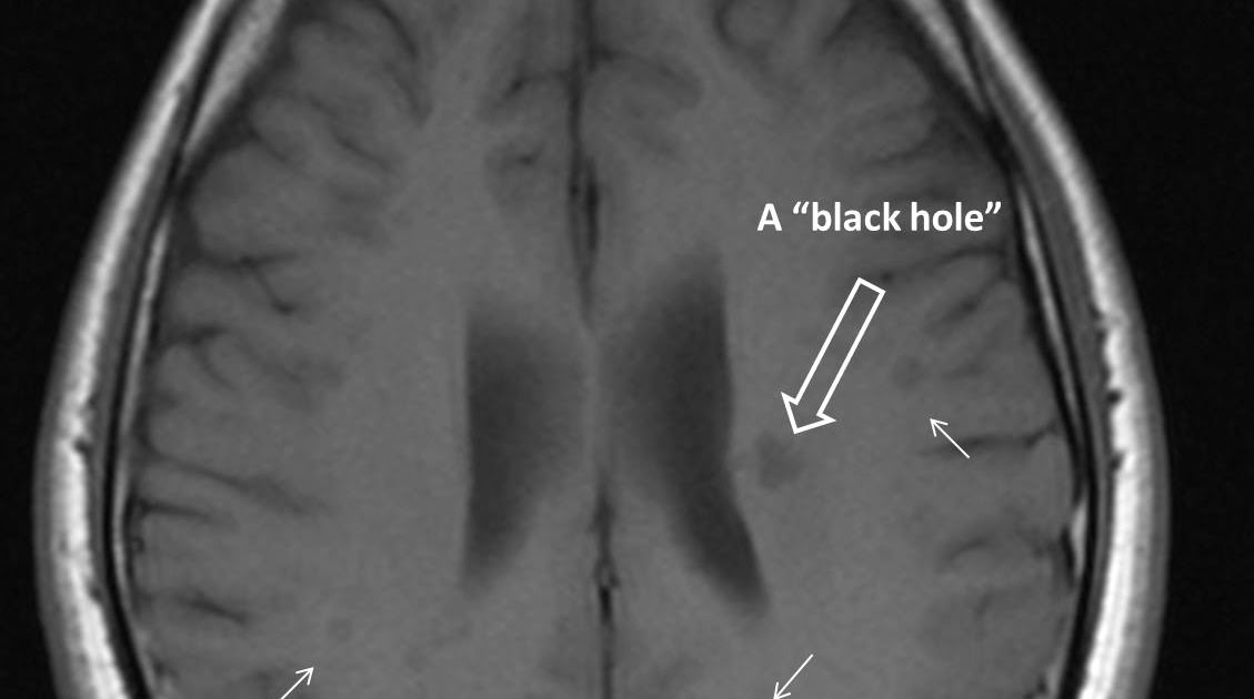 Multiple Sclerosis Research: Interferon-beta and glatiramer acetate ...