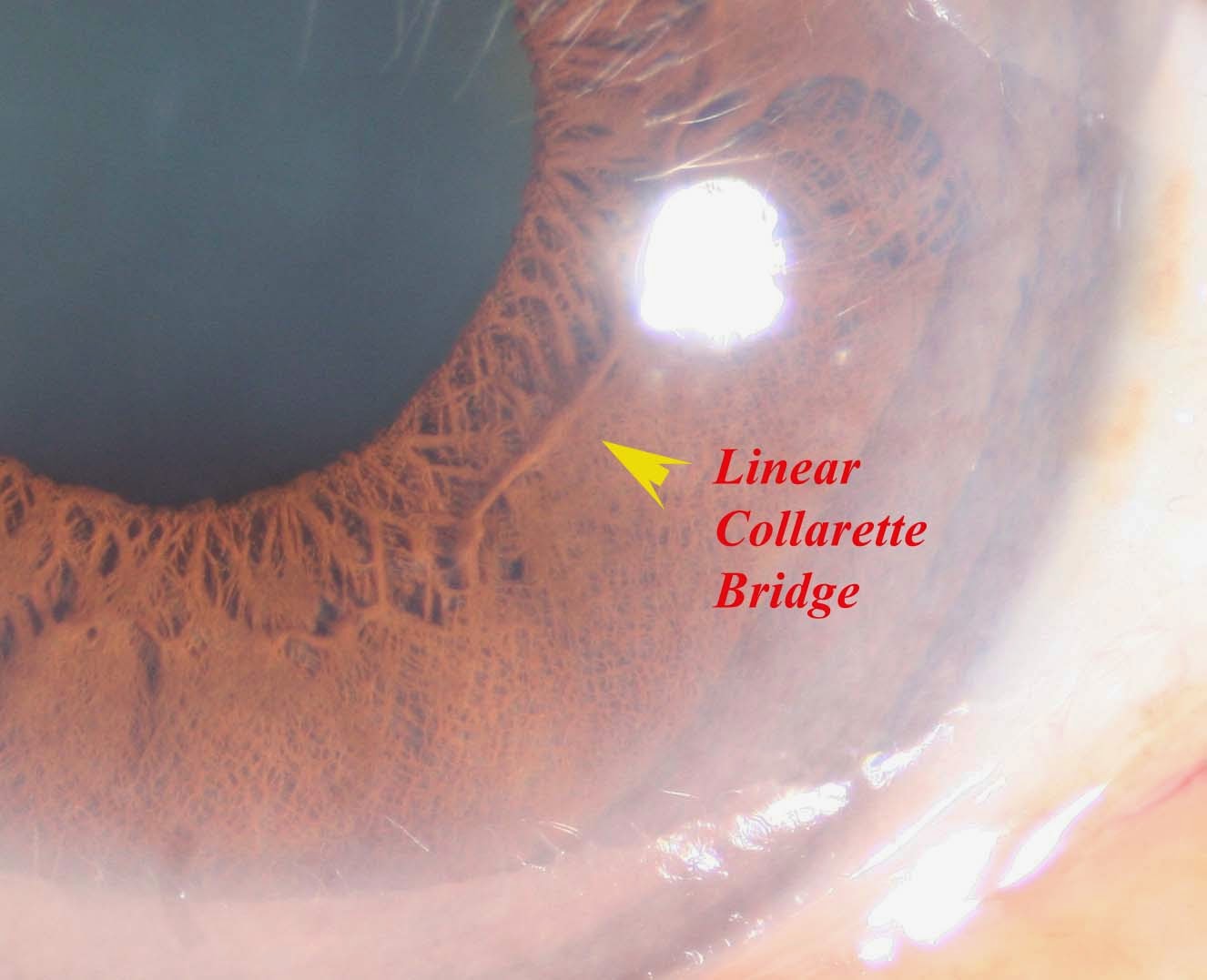 Modern & Multidimensional Iridology: Linear Collarette with Bridge ...