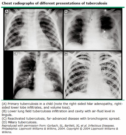 EpoportMengiau: A lil' bit of CXR