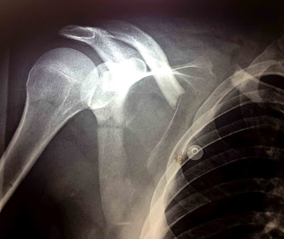 O R T O C R I T I C A: Fractura de Clavicula/escapula con lesió ...