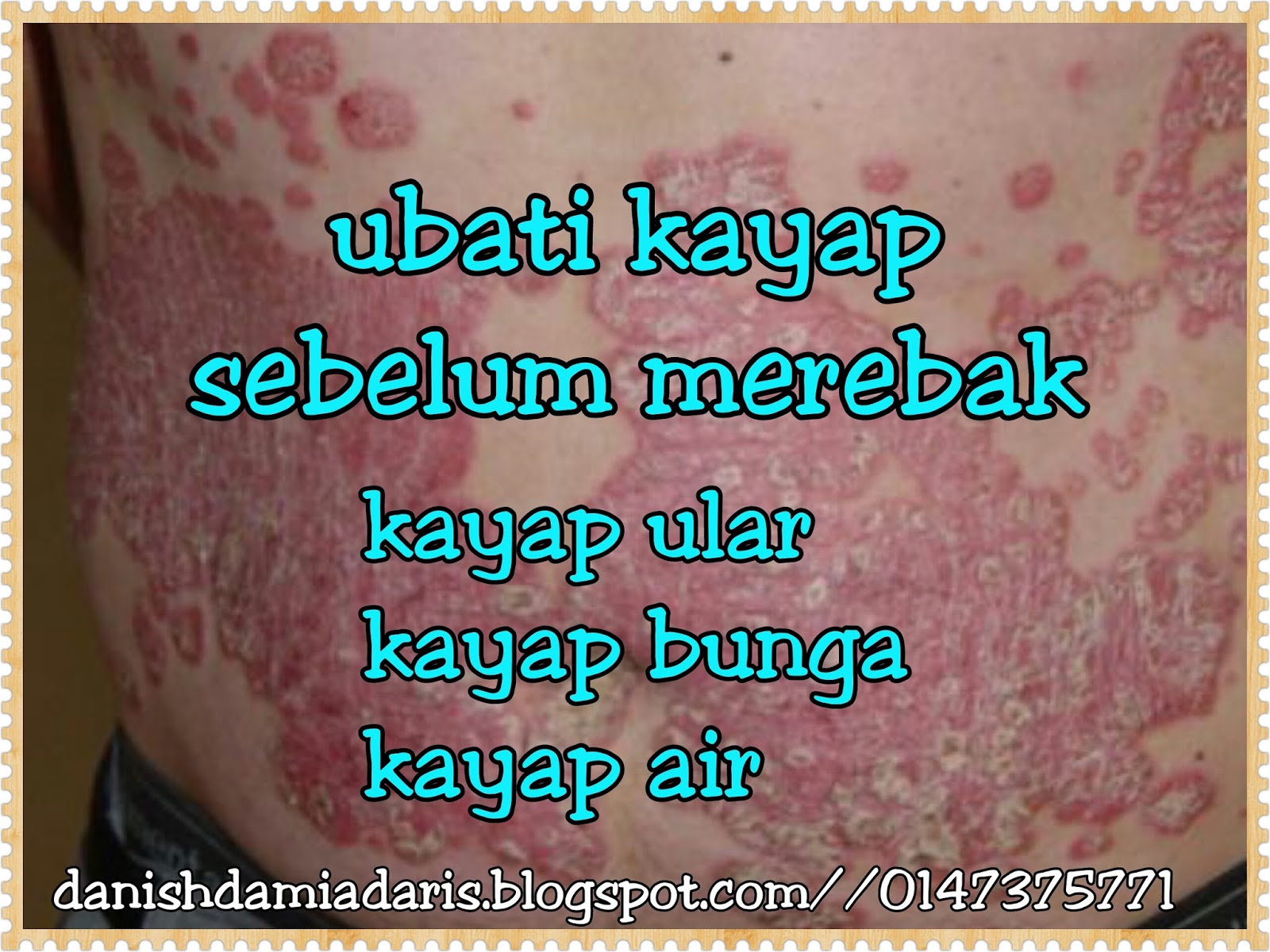 3D health beauty supplement: KENALI GEJALA, TANDA KOMPLIKASI DAN ...