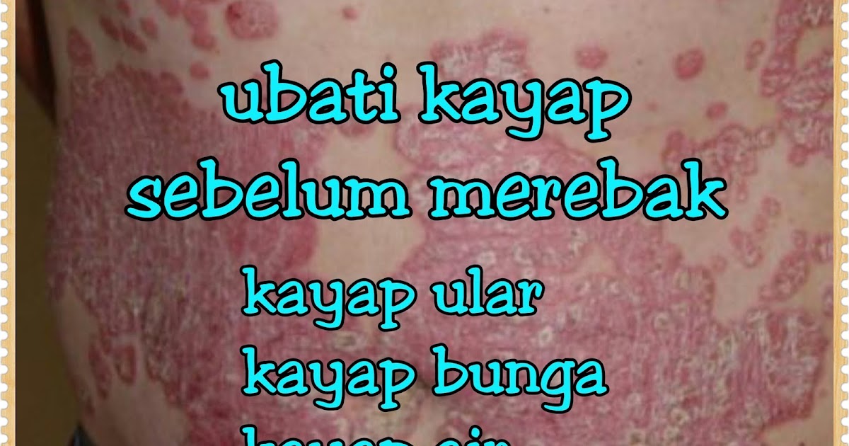 3D health beauty supplement: KENALI GEJALA, TANDA KOMPLIKASI DAN ...