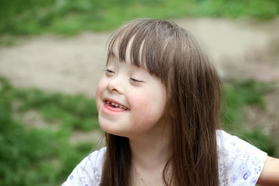 "Sindrom Down: Kondisi Akibat Kelebihan Kromosom"