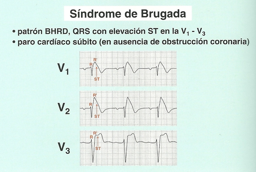 Dr. Rafael Soto - Electrocardiografía - Cardiología clínica: Síndrome ...