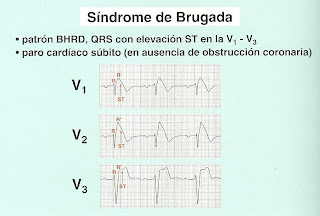 Electrocardiograma: Síndrome de Brugada