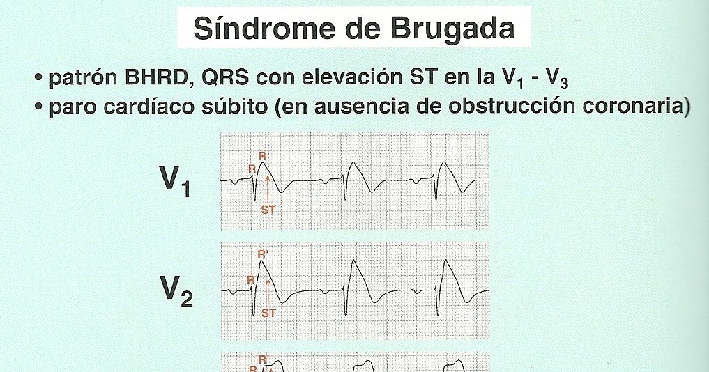 Electrocardiograma: Síndrome de Brugada