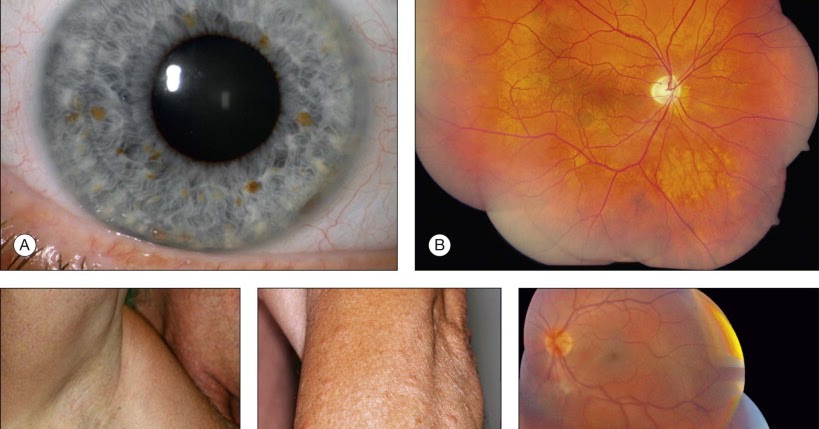 Prepare for Medical Exams : Concerning Neurofibromatosis Type 1 (NF1)...
