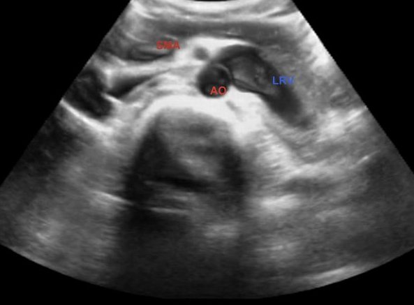 Nutcracker Syndrome-Ultrasound - Sumer's Radiology Blog