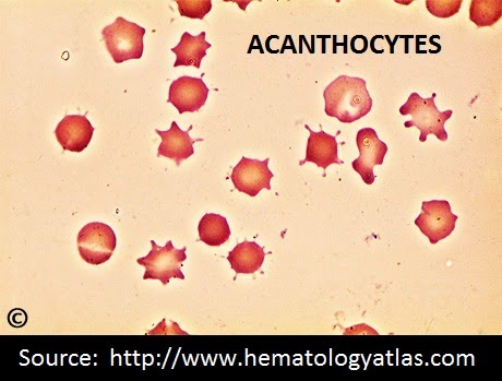 Lab Atlas: Acanthocytes