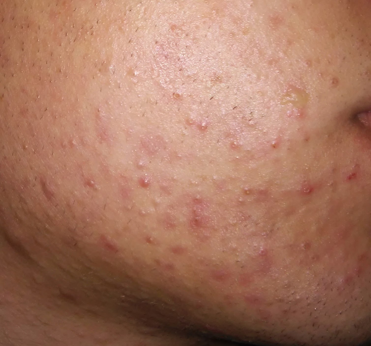 BLOG do IGOR G: Como controlar e combater as acnes e cravos no rosto?