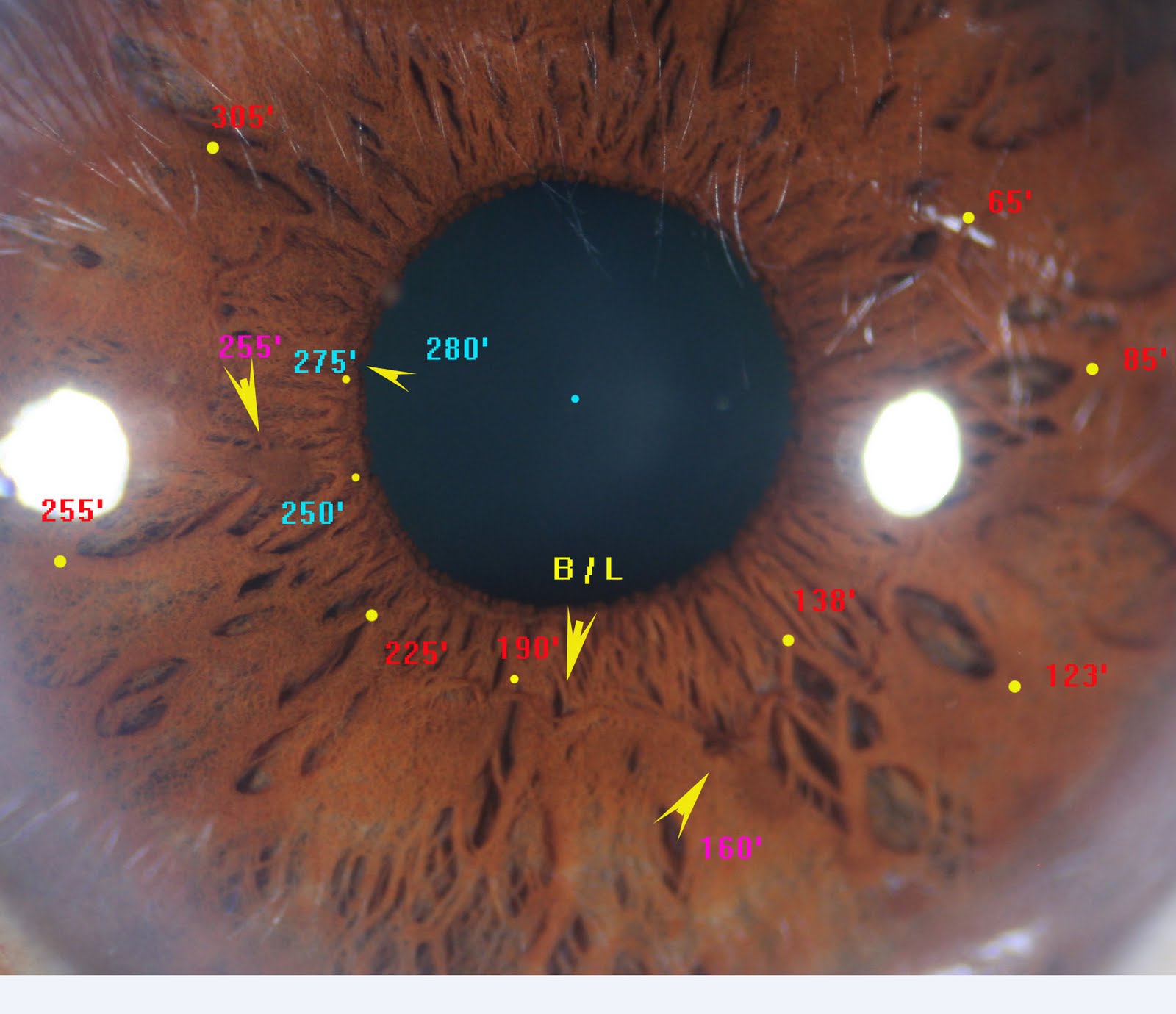Modern & Multidimensional Iridology: Localised Absence of IPB, Pupil ...