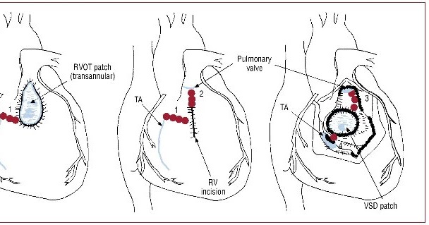 Right Ventricular Outflow Tract Tachycardia | INA - ECG