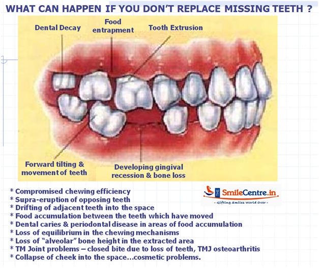 Missing Teeth - The Problems & Solutions