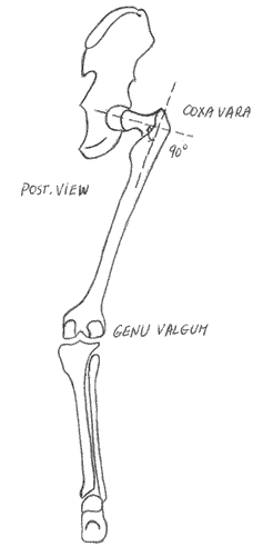 Coxa vara ~ Anatomy for MSP