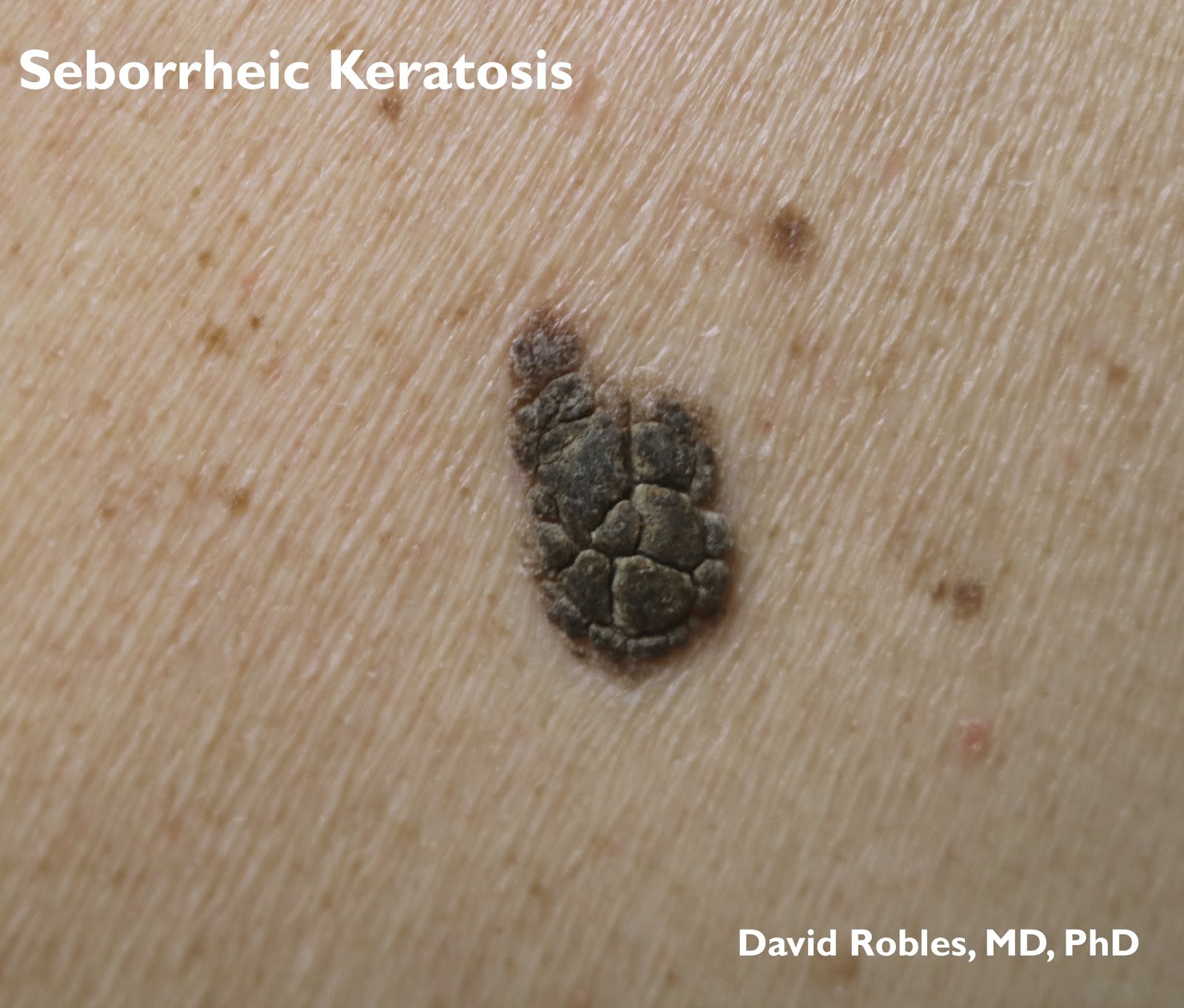 Seborrheic Keratoses: Some people call them "age spots," I call them ...