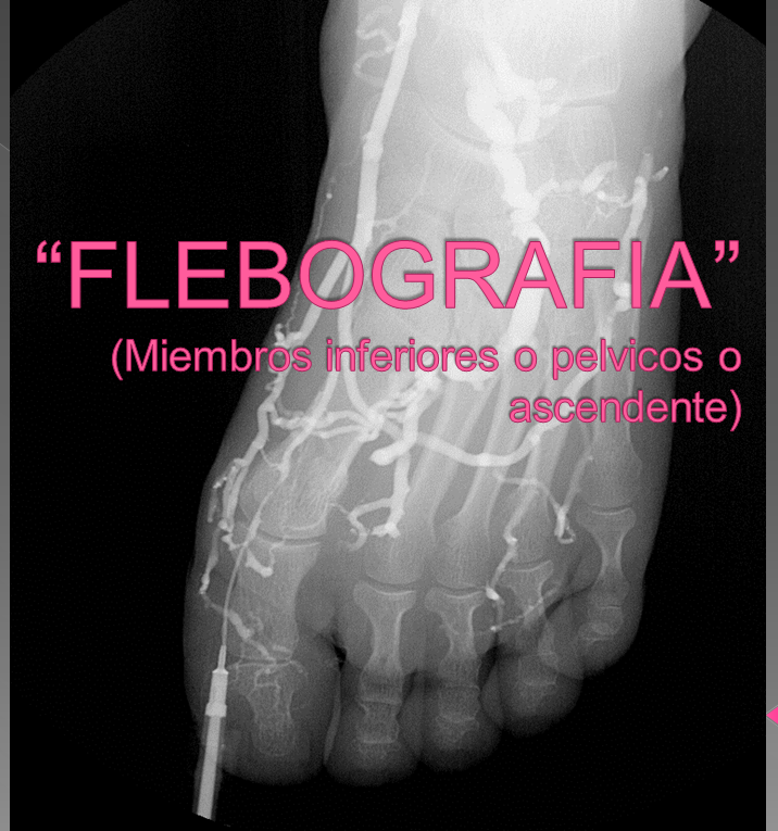 RADIOLOGIA e IMAGEN CETIS 76: FLEBOGRAFIA (extremidades inferiores)