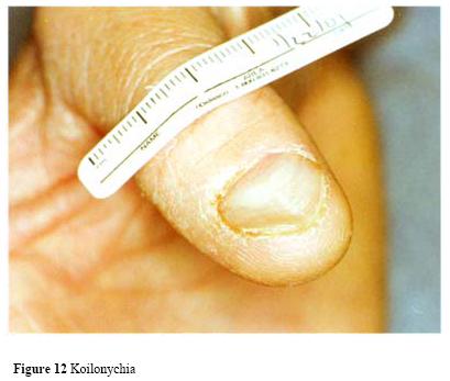 Nail Diseases: Koilonychia