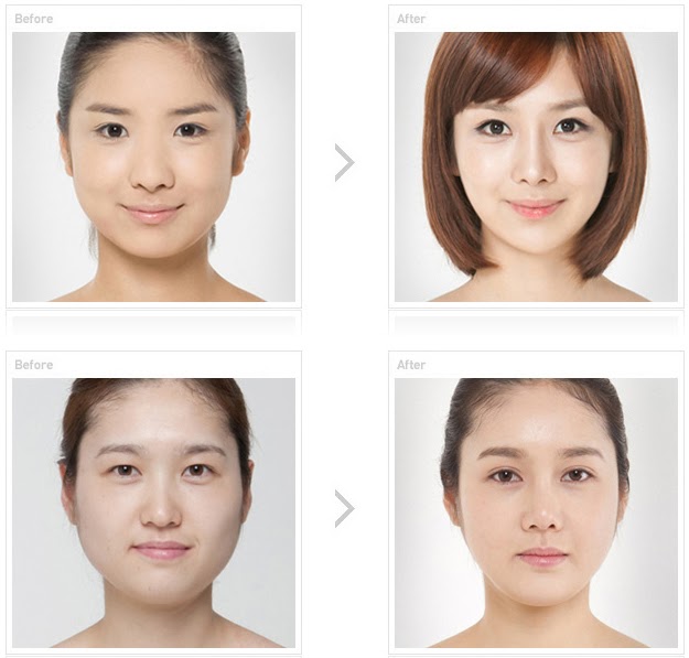 Grand Plastic Surgery: Square Jaw Reduction
