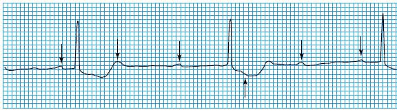 Third degree atrioventricular block / Complete heart block - ECG