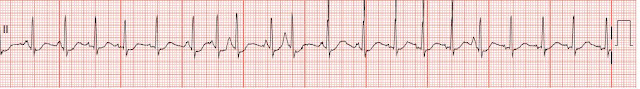 EKG Rhythm Strip Quiz 53: Atrial Rhythms