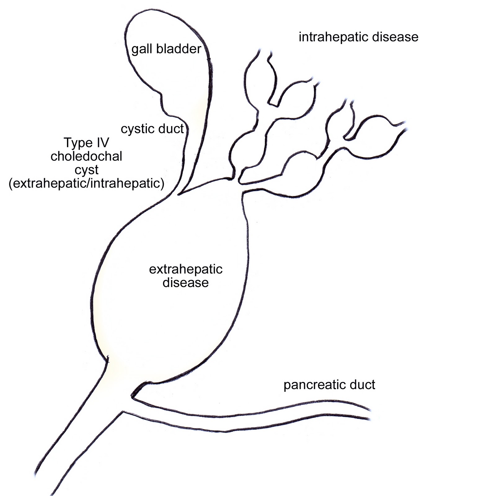 ABC Radiology Blog: Todani Classification Of Bile Duct Cysts