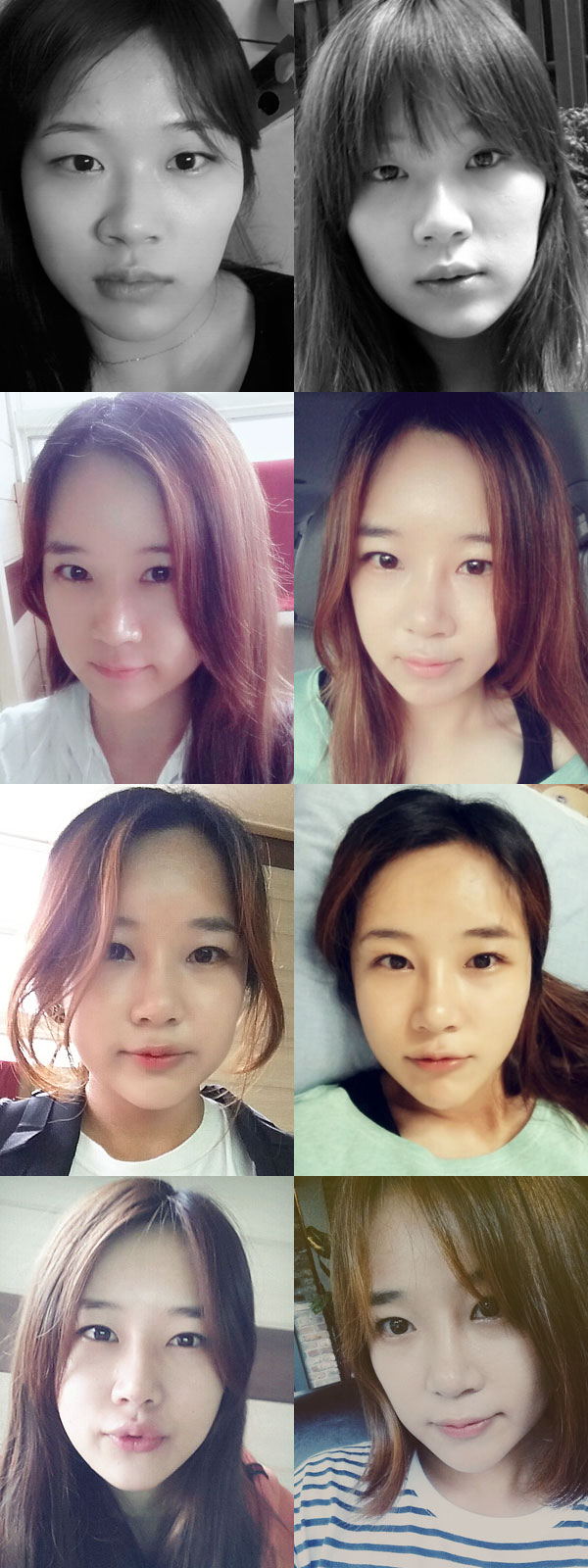 Regen Plastic Surgery Korea: Before and After SELFIES, Operation ...