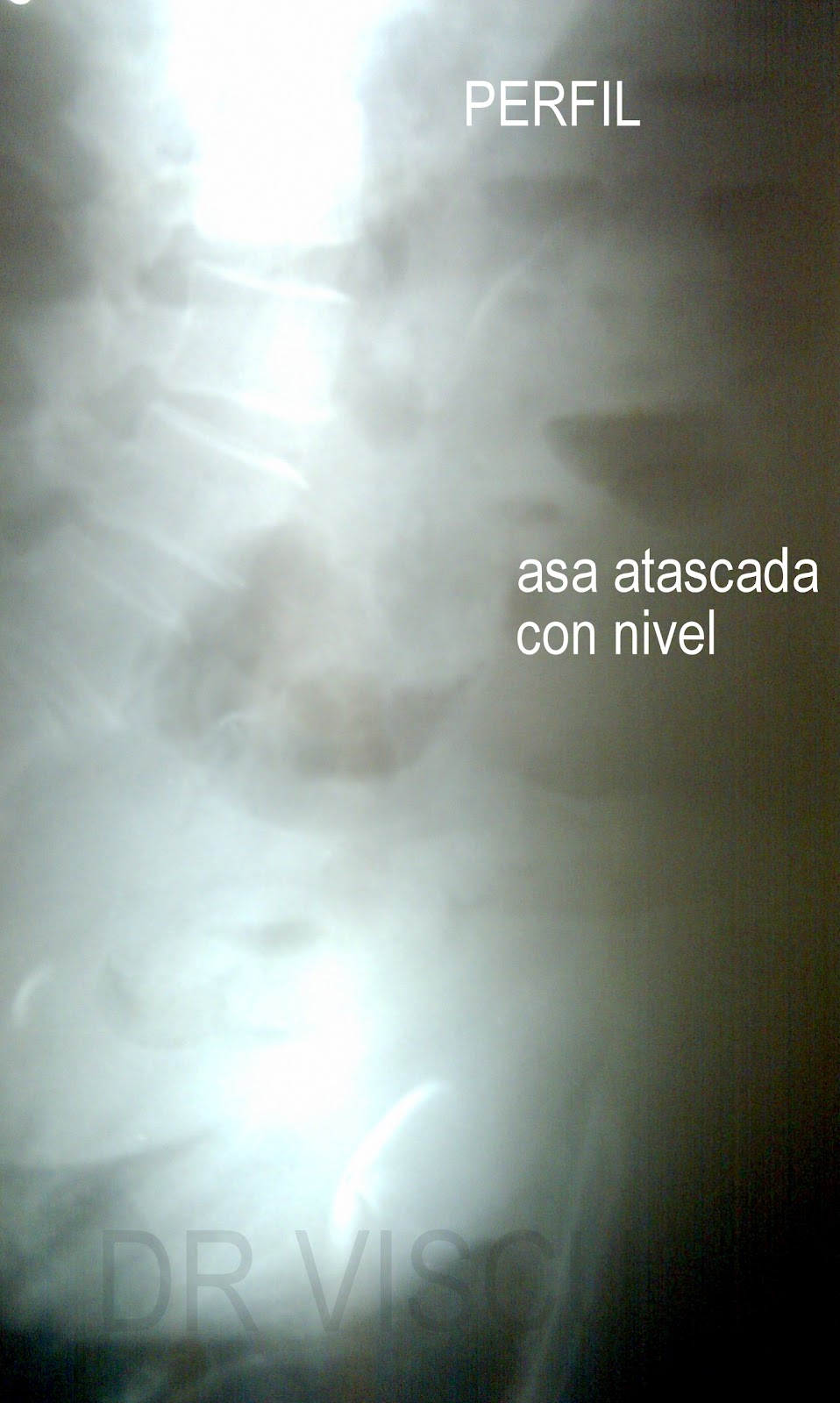 Que vi hoy: Eventración atascada