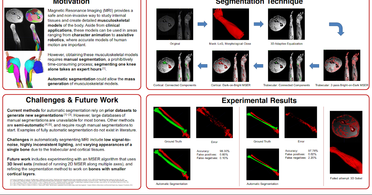 Automatic Magnetic Resonance Imaging (MRI) Bone Segmentation
