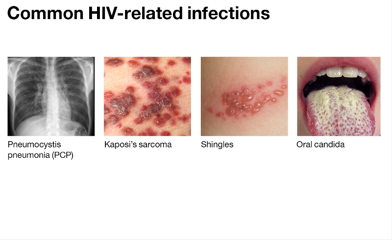 Lumalalang kaso ng HIV sa bansa