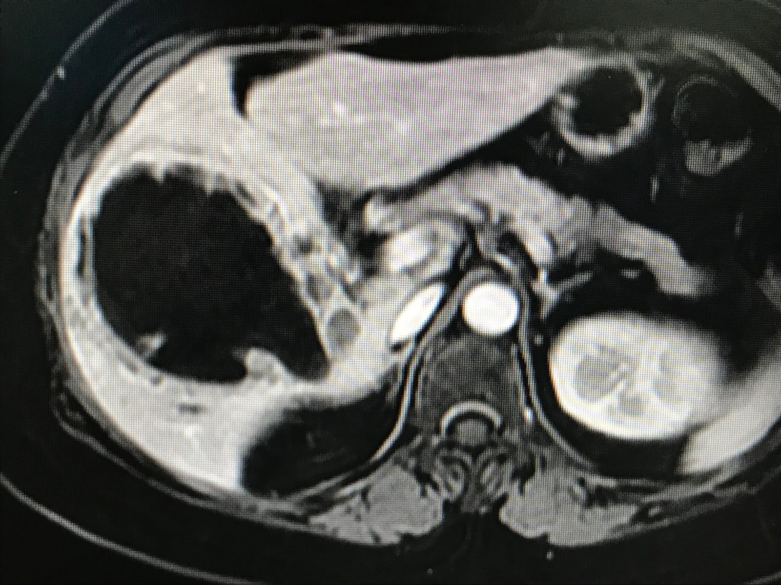 VIETNAMESE MEDIC ULTRASOUND: CASE 498: GALLBLADDER ABSCESS, Dr PHAN ...