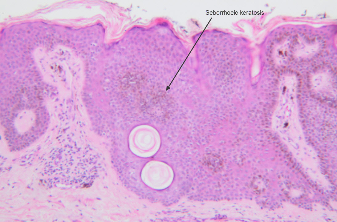 Consultations in Dermatoscopy: Three cases