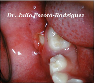 Casos de Cirugía Bucal y Maxilofacial : Caso No.22: Fístula Facial por ...