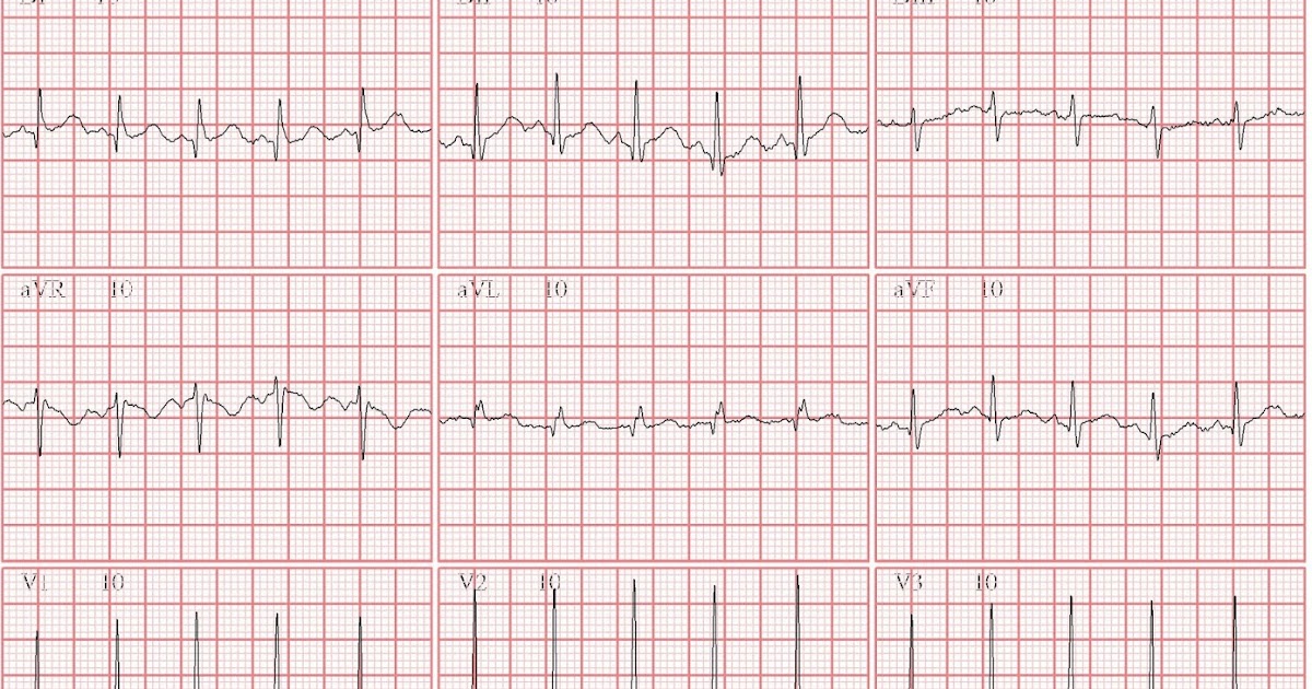 Negri Métodos Gráficos: Taquicardia sinusal, normal