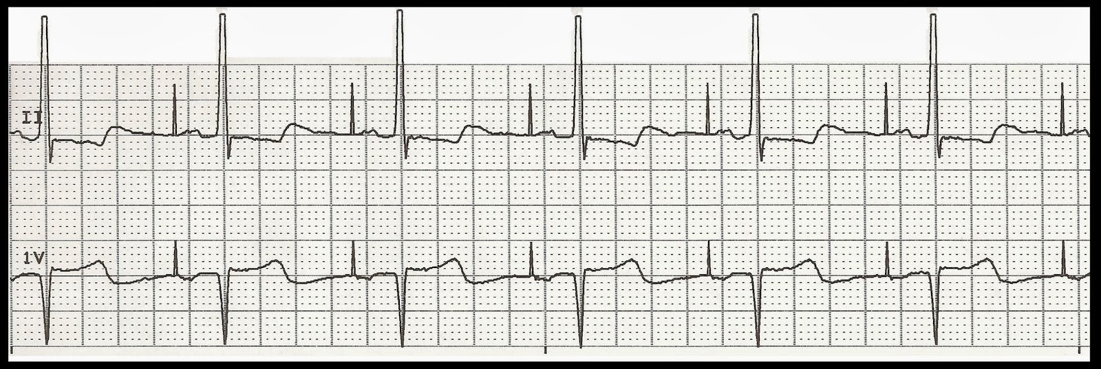 Practice EKG Rhythm Strips 232