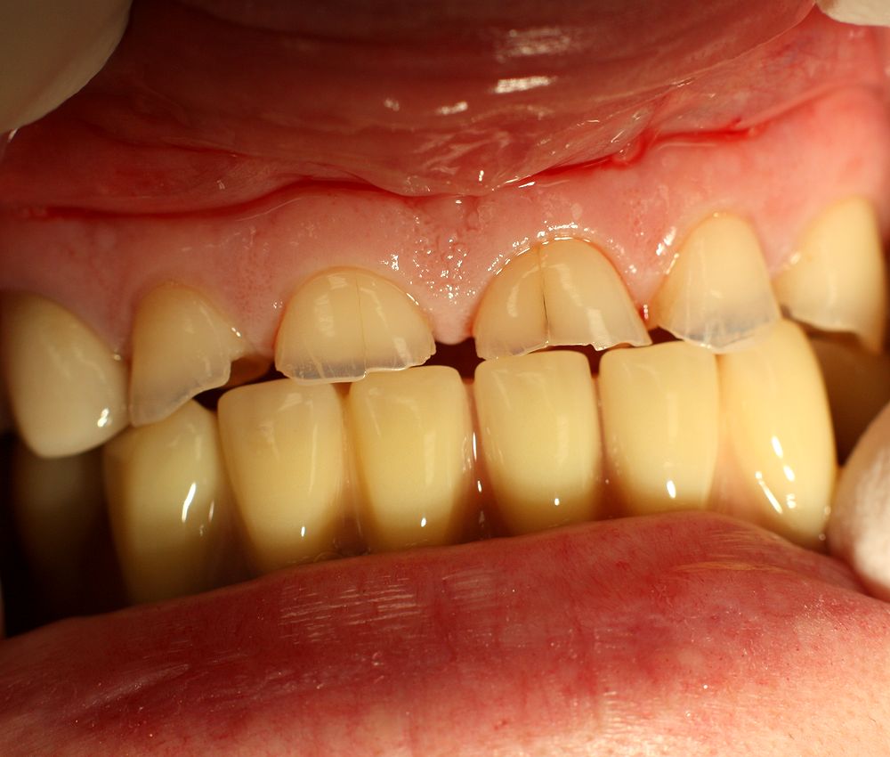 MEDICINA BUCAL : Lesiones no cariosas: atrición, erosión, abrasión ...