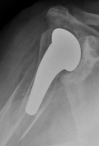 UW Shoulder and Elbow Academy: Short stem press fit humeral component ...