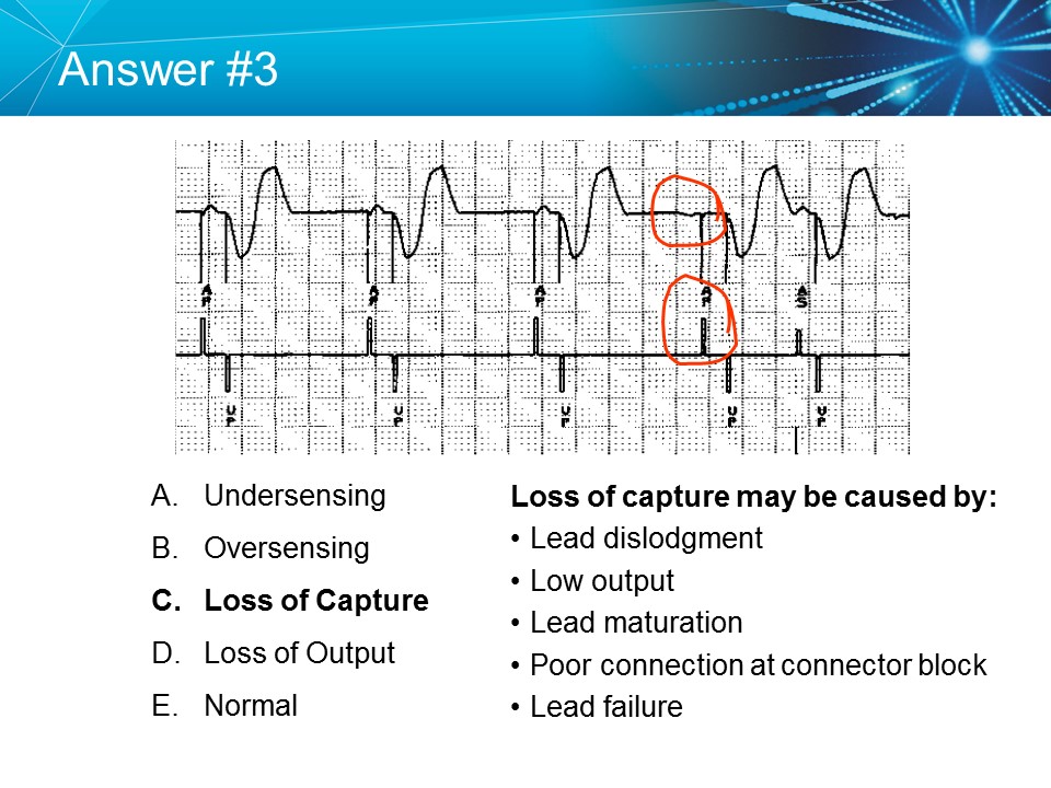 CVT Mohd Farid: Basic Pacemaker Troubleshooting Part II-Medtronic Academy