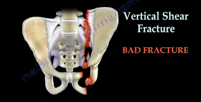 Dr. Nabil Ebraheim's Blogspot: Pelvic Fractures with Bleeding