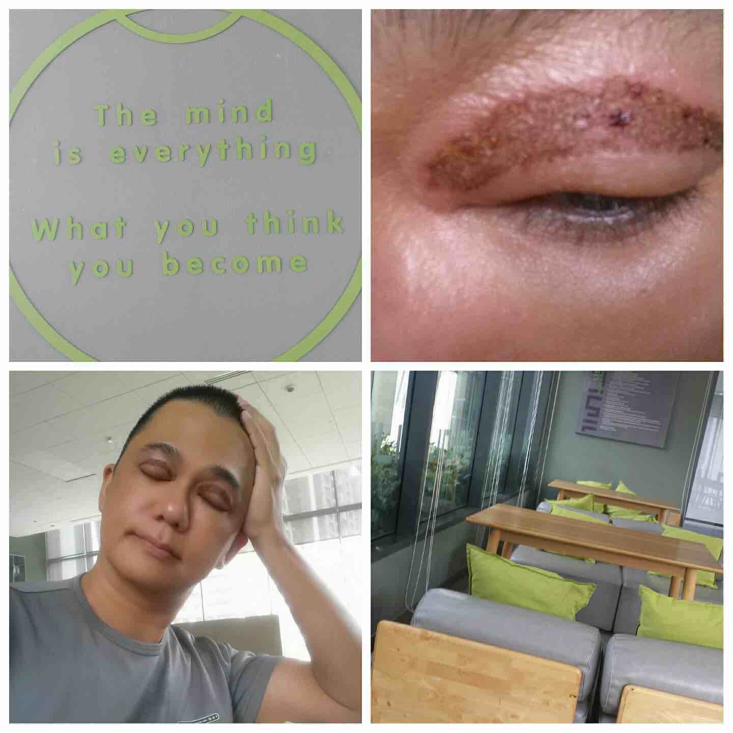 Bangkok WOW: LIFTING MY HOODED EYELIDS WITH PLEXR