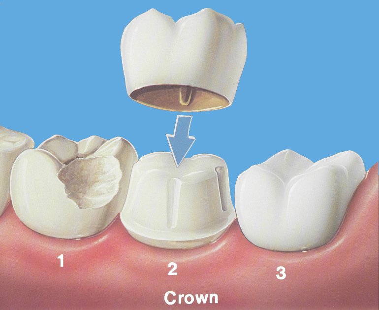 Tooth & Gums: Dental Crowns