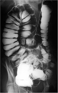 RADIOLOGIA IN FOCO: Meios de Contraste