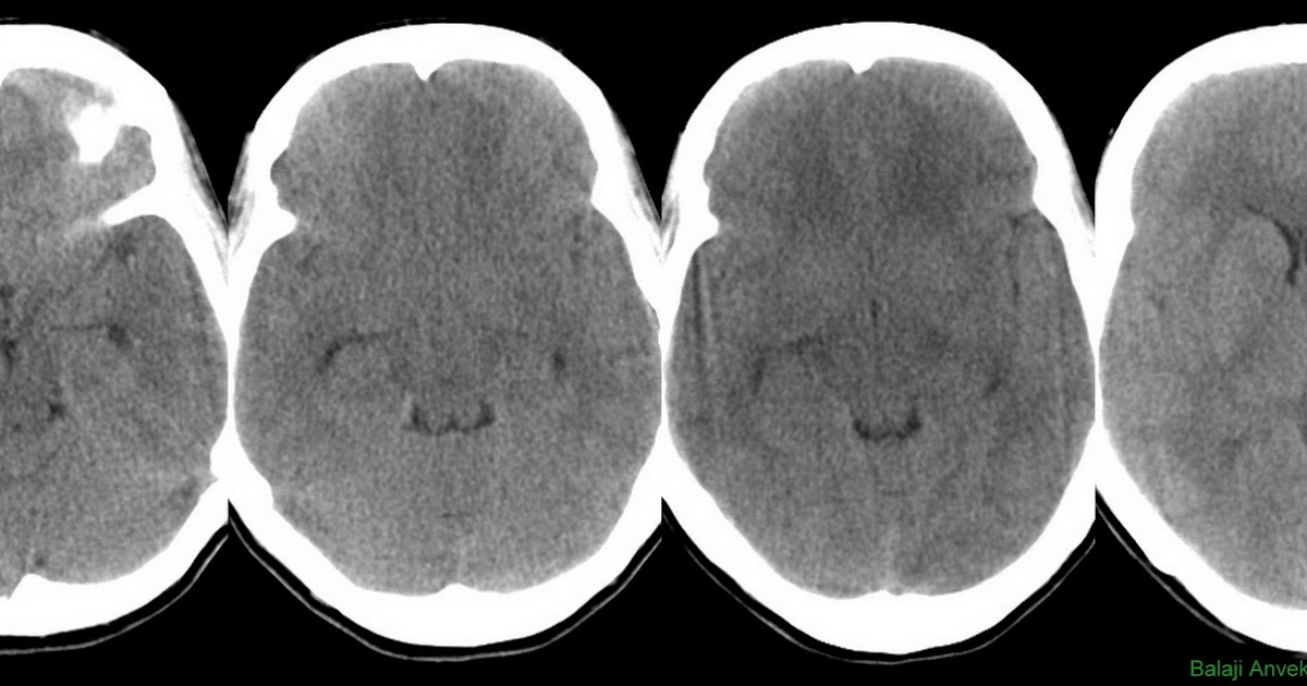 Dr Balaji Anvekar FRCR: Isolated sagging of frontal lobe
