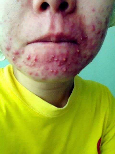Colour my sun.: Acne Horror