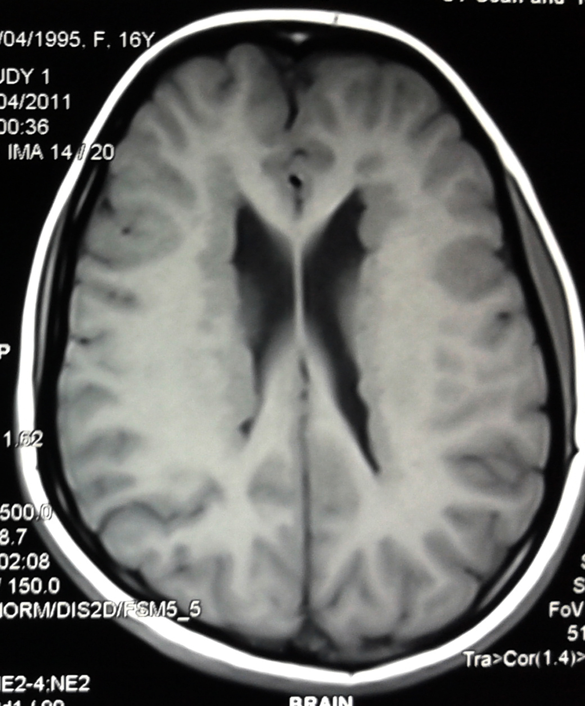 Radiodiagnosis - Imaging is Amazing-Interesting cases: Gray matter ...