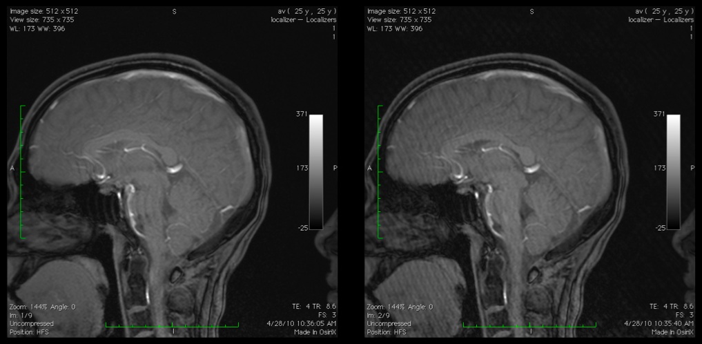 practiCal fMRI: the nuts & bolts: Rare intermittent EPI artifacts ...