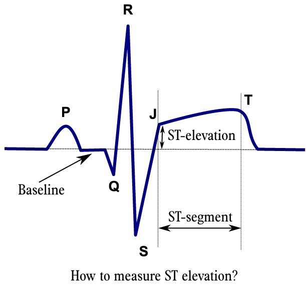 Morfologi Gelombang ST
